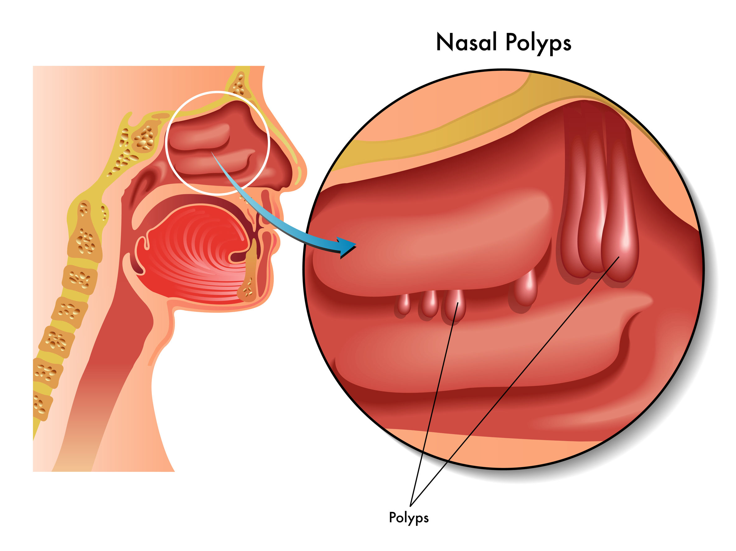 Nasal Polyps Spain PDF PPT Case Reports Symptoms Treatment