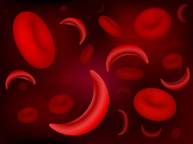 Sickle Cell Anemia United states PDF PPT Case Reports Symptoms