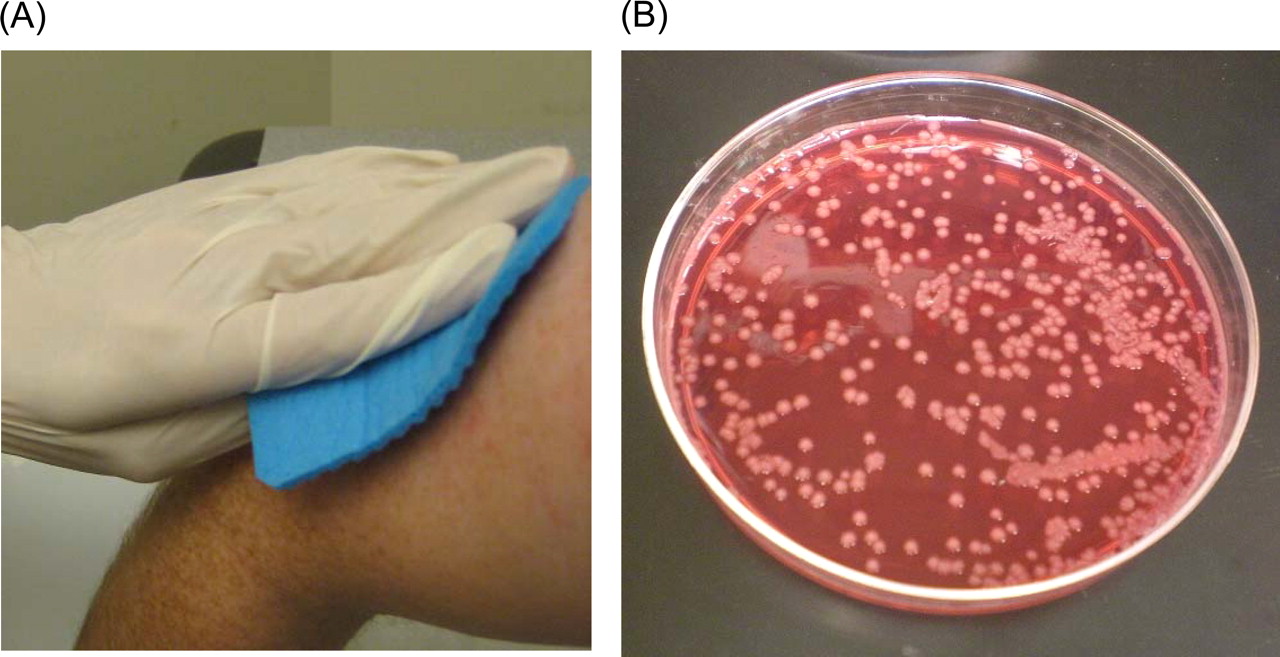 Acinetobacter Infection | Japan| PDF | PPT| Case Reports | Symptoms ...