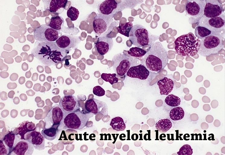 Acute myelogenous leukemia | Canada| PDF | PPT| Case Reports | Symptoms | Treatment