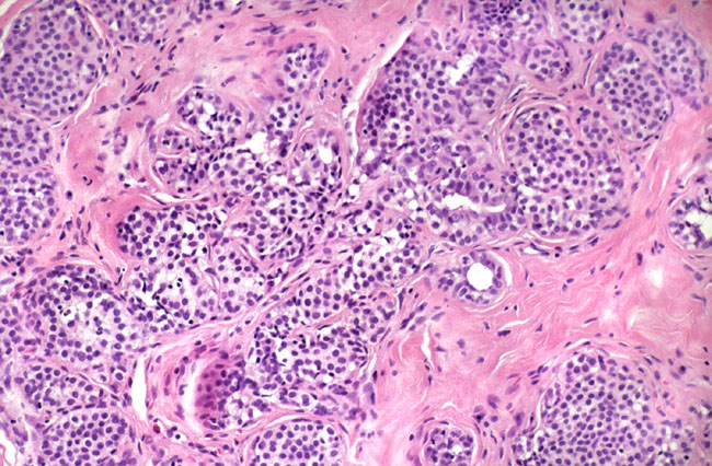 Atypical hyperplasia of the breast | Ireland| PDF | PPT| Case Reports ...