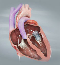 Ballooning mitral valve syndrome