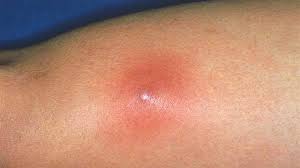 Carbuncle Pictures Causes Symptoms And Treatment