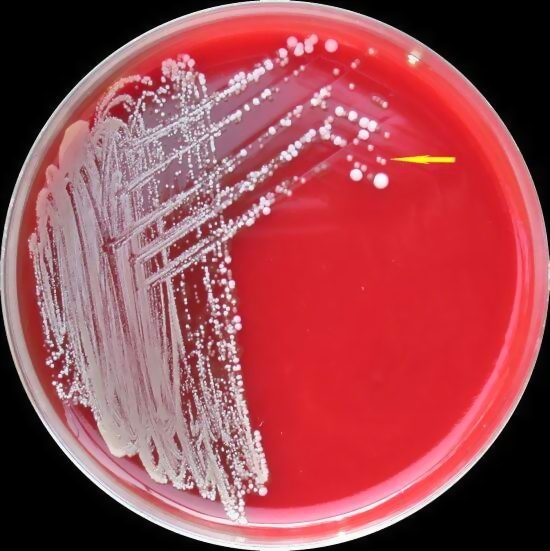Burkholderia cepacia Infection | Argentina| PDF | PPT| Case Reports ...
