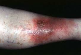 Cellulitis | Germany| PDF | PPT| Case Reports | Symptoms | Treatment
