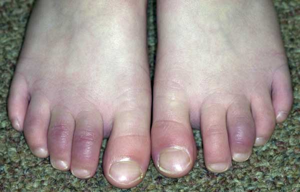 Chilblains