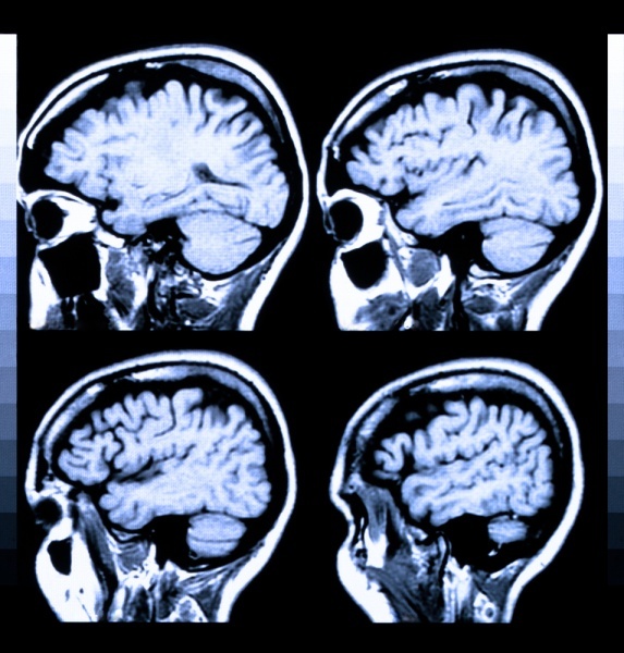 Which Chronic Traumatic Encephalopathy