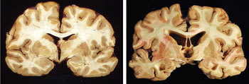 Which Chronic Traumatic Encephalopathy