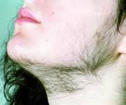 Congenital adrenal hyperplasia