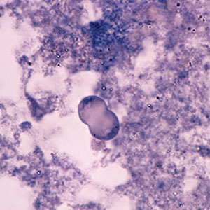 Dientamoeba fragilis Infection
