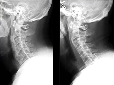 Diffuse idiopathic skeletal hyperostosis