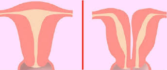 Double uterus | Israel| PDF | PPT| Case Reports | Symptoms | Treatment