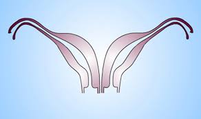 Double uterus | Israel| PDF | PPT| Case Reports | Symptoms | Treatment