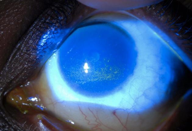 Dry eyes | UK| PDF | PPT| Case Reports | Symptoms | Treatment