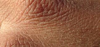 Dry Skin