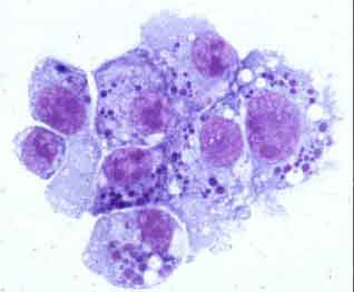 Ehrlichiosis | India| PDF | PPT| Case Reports | Symptoms | Treatment