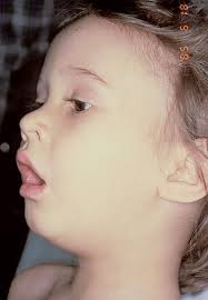 Epiglottitis | Ireland| PDF | PPT| Case Reports | Symptoms | Treatment