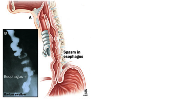 Esophagus Spasms