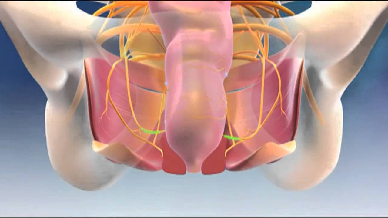 Fecal Incontinence Norway Pdf Ppt Case Reports Symptoms Treatment