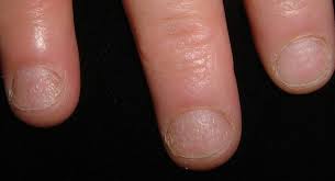 Hashimotos Skin Problems