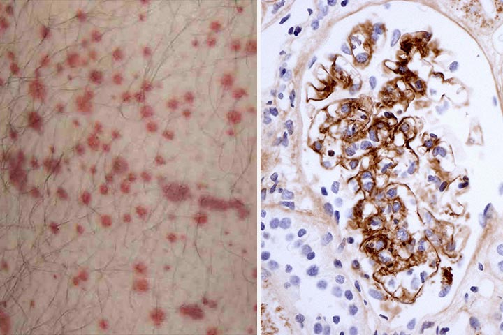 Henoch-Schonlein purpura