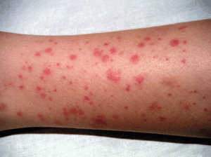 Henoch Schonlein Purpura Pathophysiology