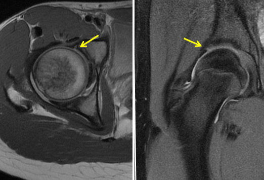 Hip labral tear | Canada| PDF | PPT| Case Reports | Symptoms | Treatment