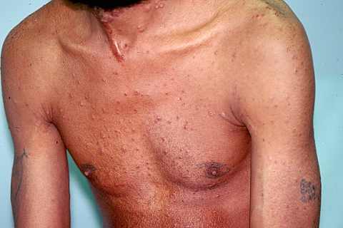 Healthool Histoplasmosis Symptoms Treatment Pictures Leishmaniasis