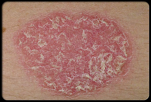 Hot Tub Rash | Singapore| PDF | PPT| Case Reports | Symptoms | Treatment
