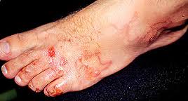 Human Hookworm | China| PDF | PPT| Case Reports | Symptoms | Treatment