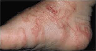 Human Hookworm | Mexico| PDF | PPT| Case Reports | Symptoms | Treatment