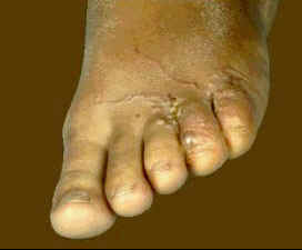 Human Hookworm | Spain| PDF | PPT| Case Reports | Symptoms | Treatment