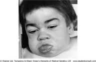 Hunter Syndrome | Ireland| PDF | PPT| Case Reports | Symptoms | Treatment