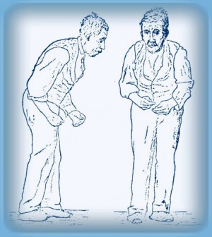 Lewy body dementia
