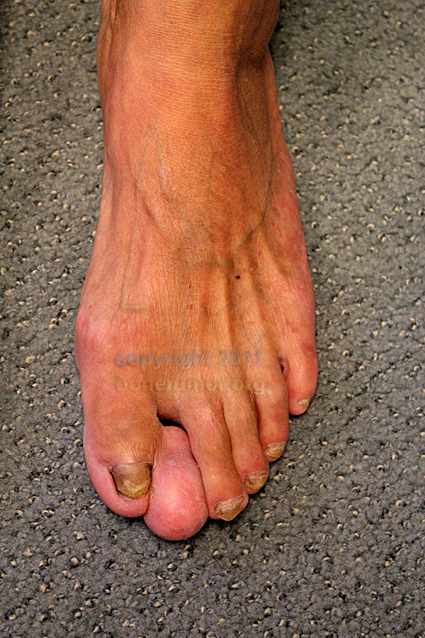 Liposarcoma | Sweden| PDF | PPT| Case Reports | Symptoms | Treatment