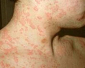 Listeriosis | India| PDF | PPT| Case Reports | Symptoms | Treatment