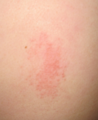 Nickel allergy | Sweden| PDF | PPT| Case Reports | Symptoms | Treatment