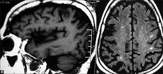Posterior Cortical Atrophy