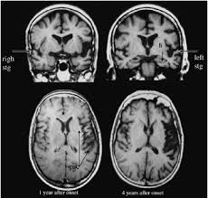 Posterior Cortical Atrophy