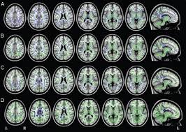 Posterior Cortical Atrophy
