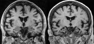 Posterior Cortical Atrophy