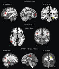 Posterior Cortical Atrophy