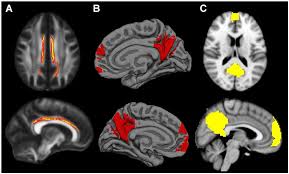 Posterior Cortical Atrophy