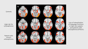 Posterior Cortical Atrophy