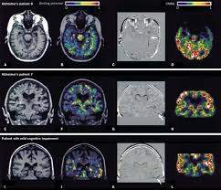 Posterior Cortical Atrophy