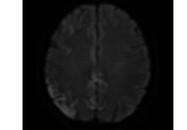 Posterior Cortical Atrophy