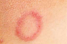 Ringworm (Body) | Canada| PDF | PPT| Case Reports | Symptoms | Treatment