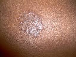 Ringworm African American
