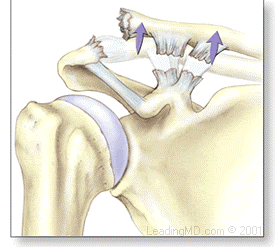 Separated Shoulder | Sweden| PDF | PPT| Case Reports | Symptoms | Treatment