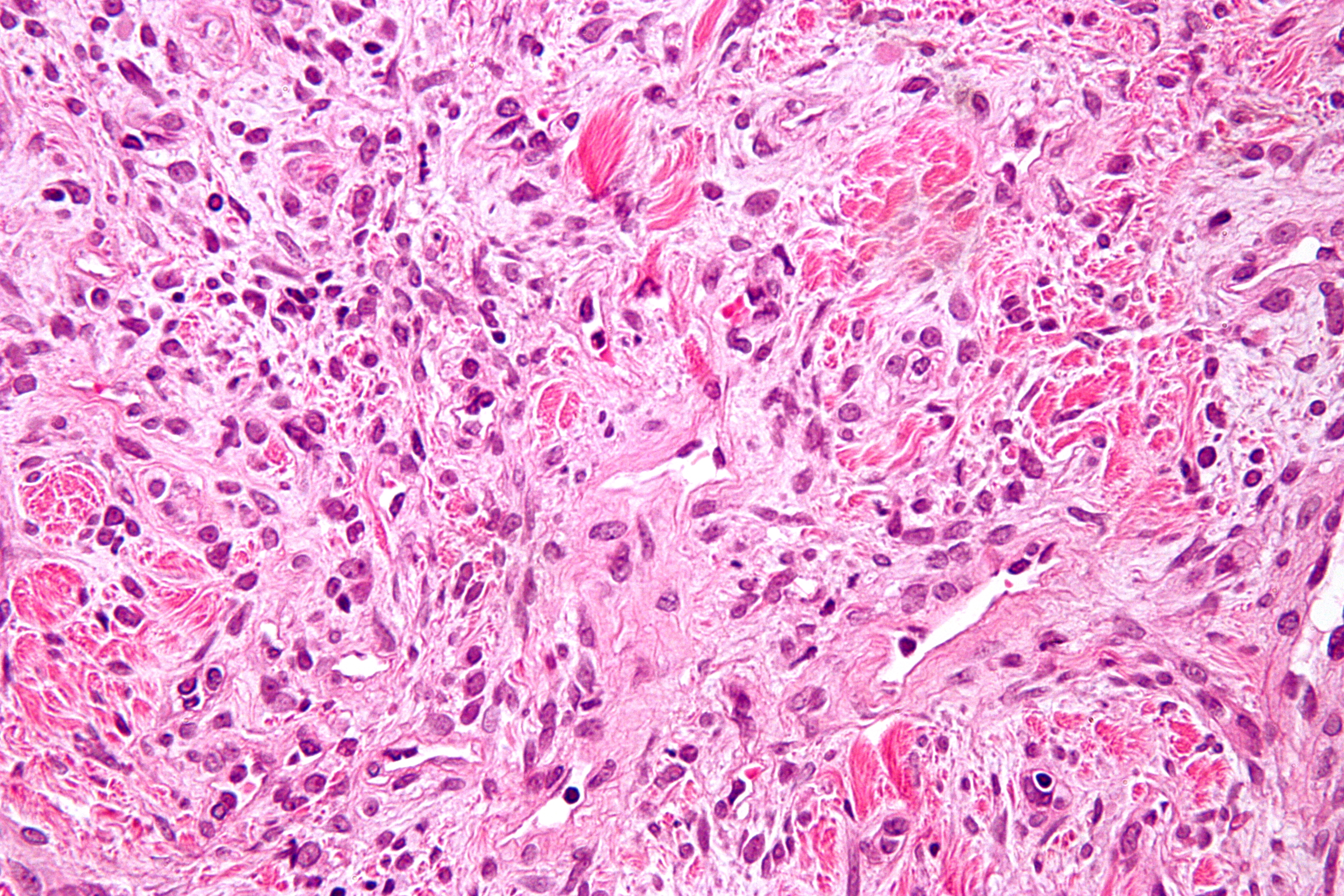 Solitary Fibrous Tumorssft Israel Pdf Ppt Case Reports Symptoms Treatment